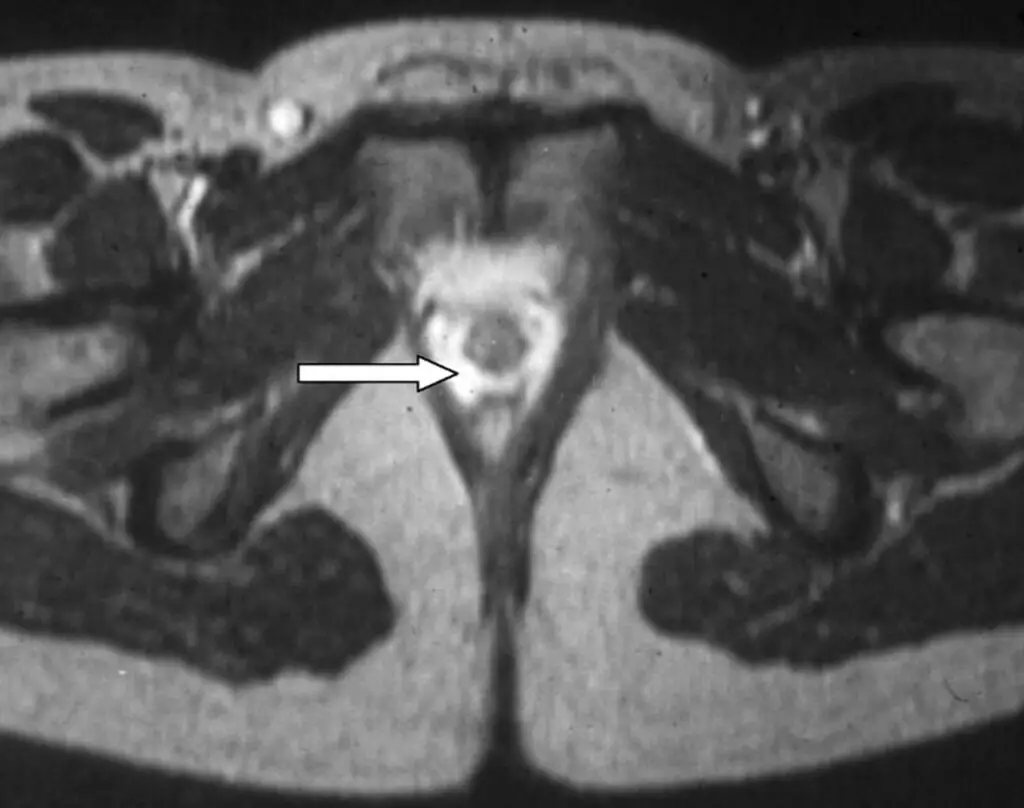 Agenezija vagine (nerazvijena vagina) - Simptomi
