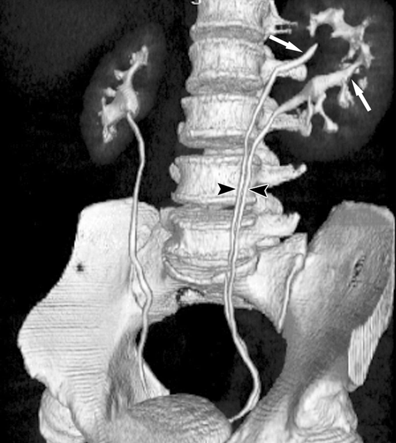 Duplirani ureter (urether duplex) - Simptomi