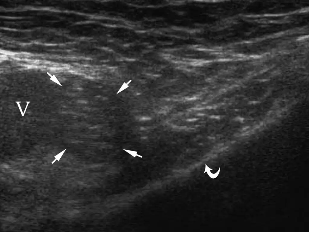 Prelomi donjeg (distalnog) okrajka tibije - Simptomi