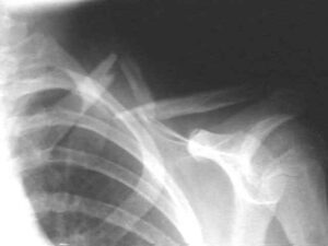 Prelomi karlice (fracturae pelvicis) - Simptomi