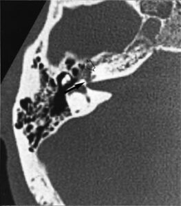 Prelomi temporalne kosti (fracturae ossis temporalis) - Simptomi