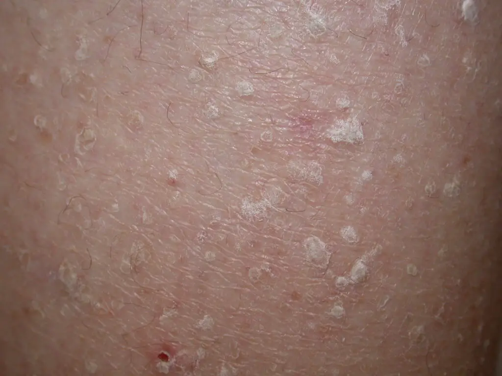 Stuccokeratosis - Simptomi