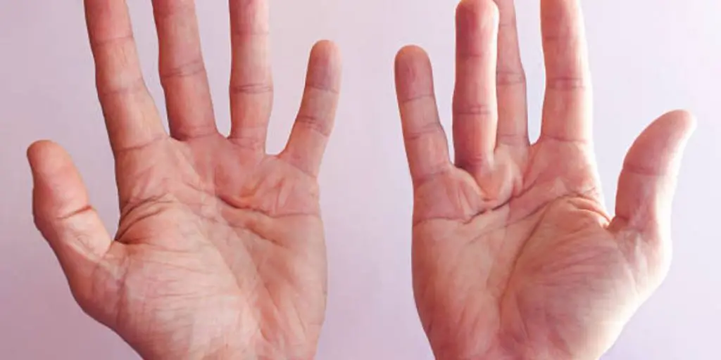 Entezopatija (Entezitis) zapaljenje pripoja tetiva - Simptomi