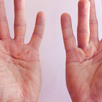 Reumatoidni artritis (reuma), simptomi, lečenje, lekovi i ishrana ...