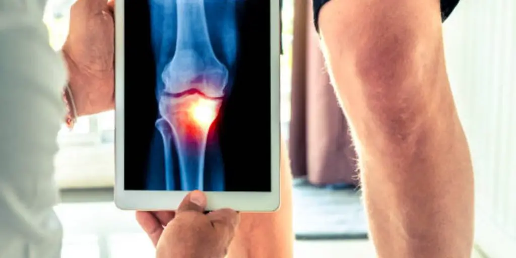 Entezopatija (Entezitis) zapaljenje pripoja tetiva - Simptomi